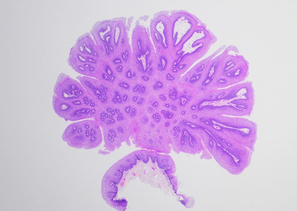 human-papillomavirus-6-in-july-2023-by-bgrunniens-squamous-papilloma