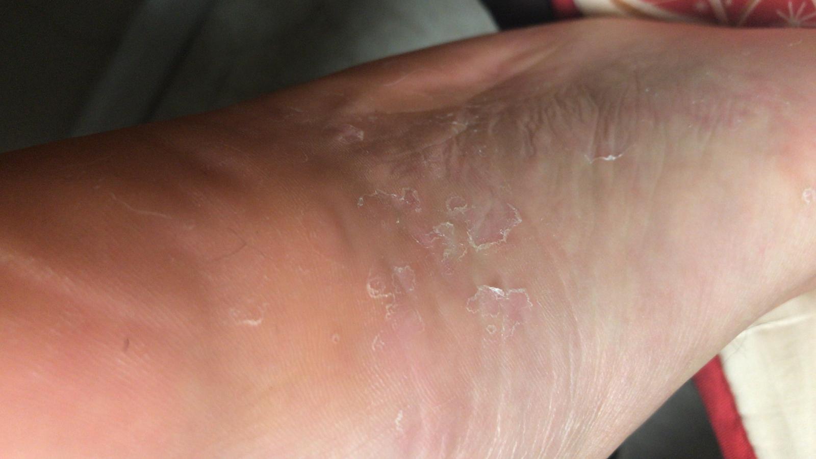 Trichophyton rubrum (Castell.) Sabour.